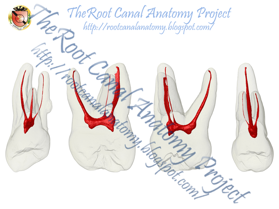 The Root Canal Anatomy Project: Maxillary First Molar