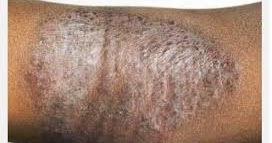 Cara Ampuh Mengatasi Kulit Gatal Kering Dan Menghitam | Info kesehatan ...