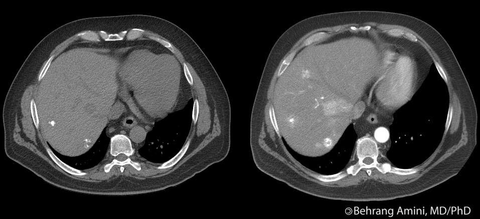 Roentgen Ray Reader: Calcified Liver Metastases
