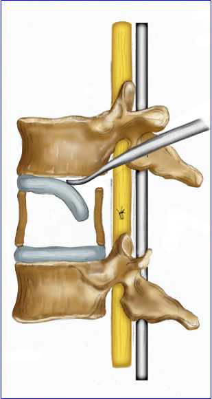 Vertebral Column Resection (VCR) in Pediatric Spinal Deformity Part 3 ...