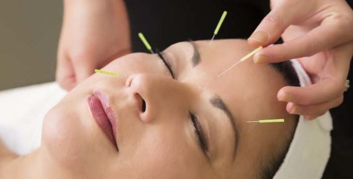 5 Benefits of Acupuncture for Beauty - Easy, Safe and Fast