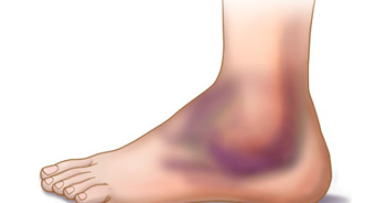 French Vocabulary Illustrated: entorse