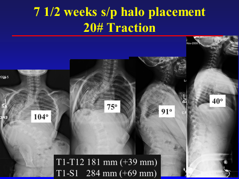 Halo-Gravity Traction | Growing Spine Blog | Washington University in ...