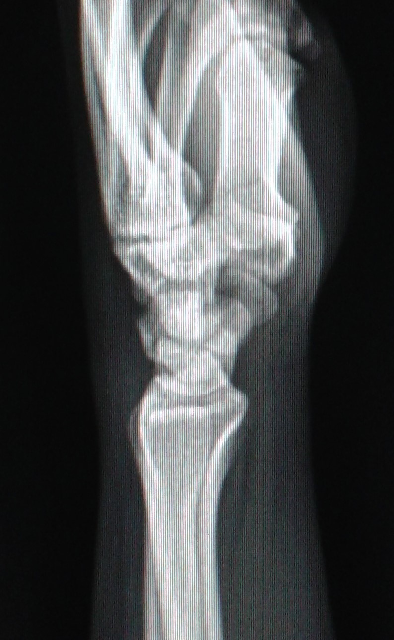 DICAS DE RADIOLOGIA: IMAGENS RADIOLÓGICAS - FRATURA DO ESCAFOIDE