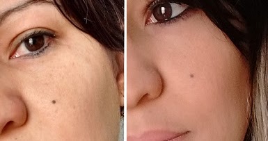 Como tirar mancha no rosto com ácidos - Toque na Vida