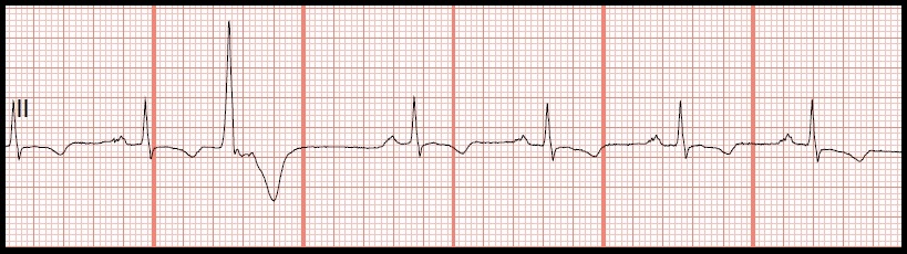 EKG Rhythm Strip Quiz 94: Ectopy and Escape Beats