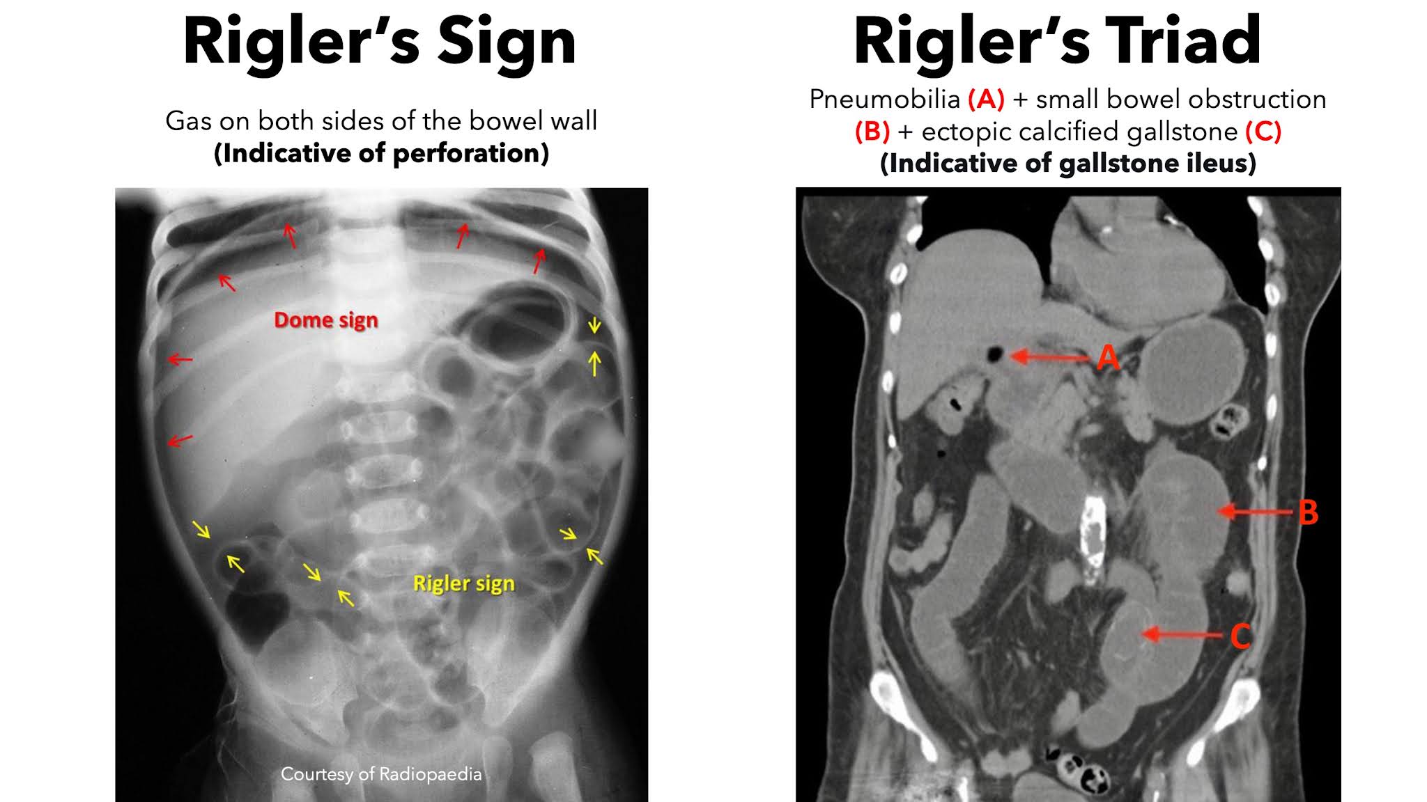 Rigler's Sign Vs Rigler's Triad