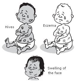 Pirmoji pagalba vaikui: Sunki alerginė reakcija/ anafilaksinis šokas