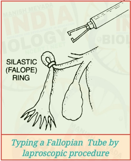 Permanent Methods of Birth control, MTP & STDs | NEET BIOLOGY