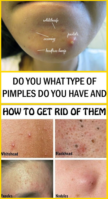 What type of pimples you have and how to get rid of them - wellness ...