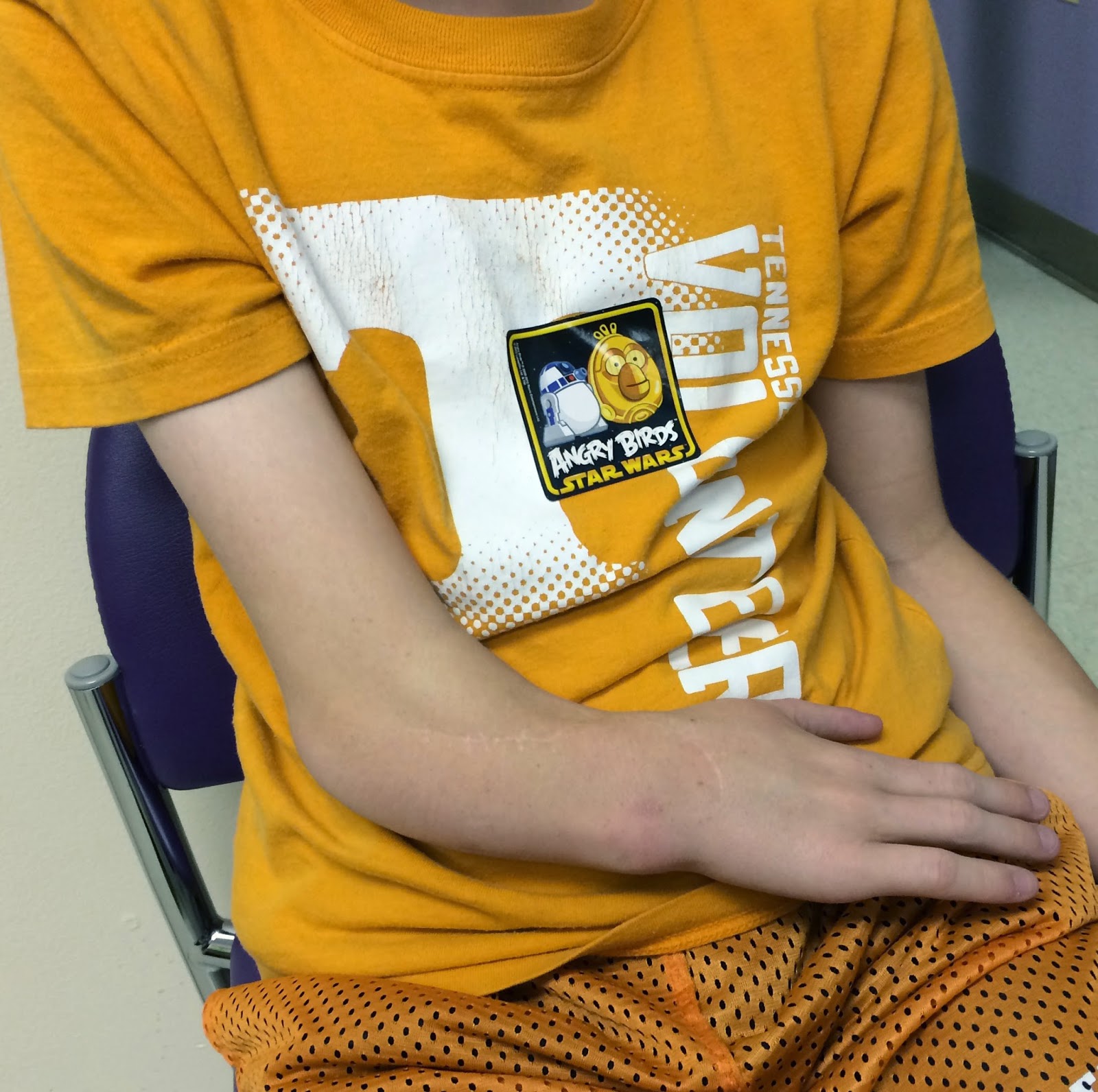 Type 2 Radial Longitudinal Deficiency | Congenital Hand and Arm ...