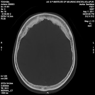 Dr Balaji Anvekar FRCR: Hyperostosis Frontalis Interna