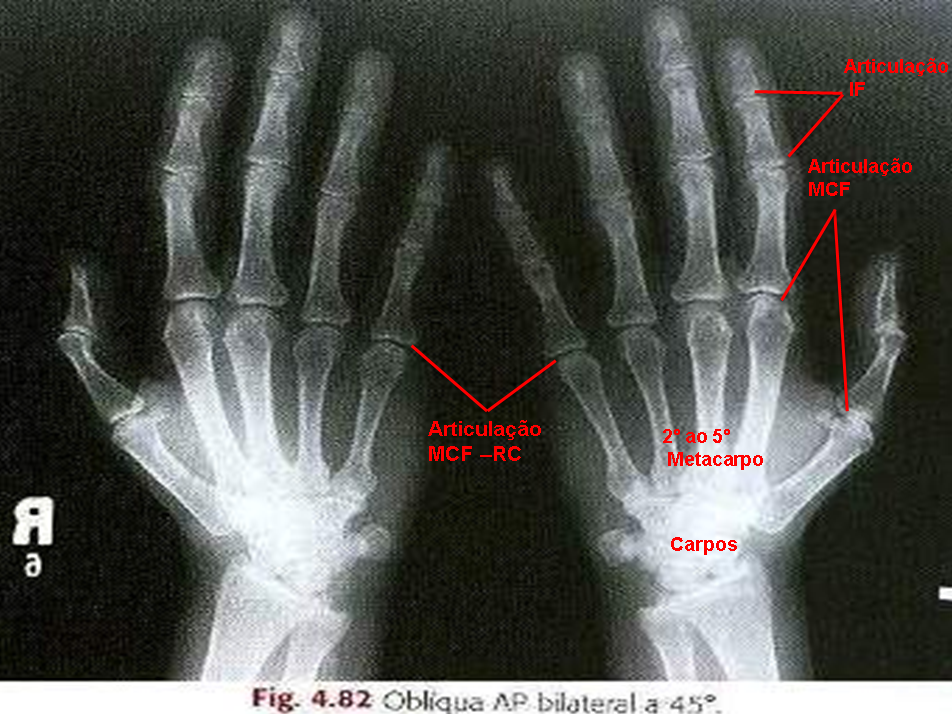 Laboratório de Roentgen: Membros Superiores Parte 1