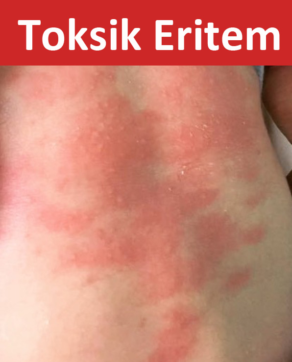 Bebeklerde Toksik Eritem - Toksik Eritem