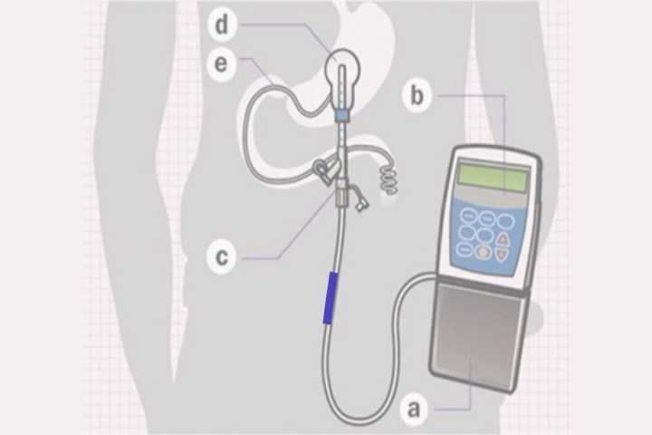 Our Parkinson's Place: Healthy Living: Duopa and Parkinson's