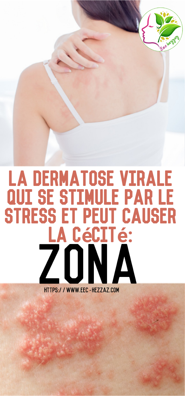 Zona : La dermatose virale qui se stimule par le stress et peut causer ...