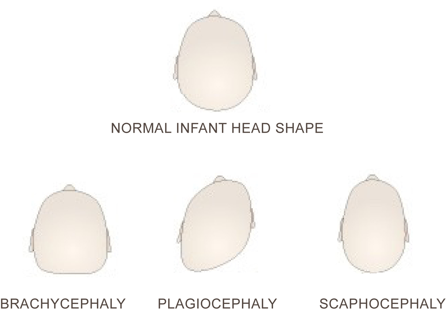 Mommyology: Let's Talk "Flat Head Syndrome": Anna's Story