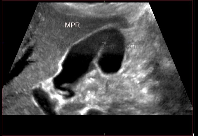 Folded Gallbladder-Ultrasound - Sumer's Radiology Blog