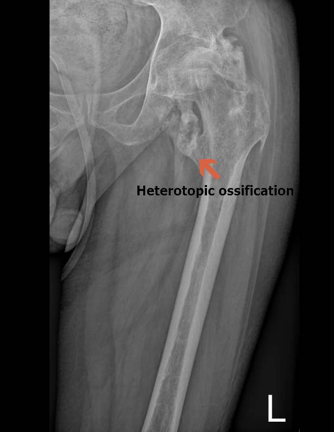 Dr. of Physical Medicine & Rehabilitation: Heterotopic ossification