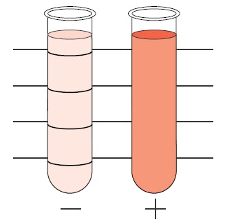 Sickle Cell Screening Procedure ~ Hematology Lectures