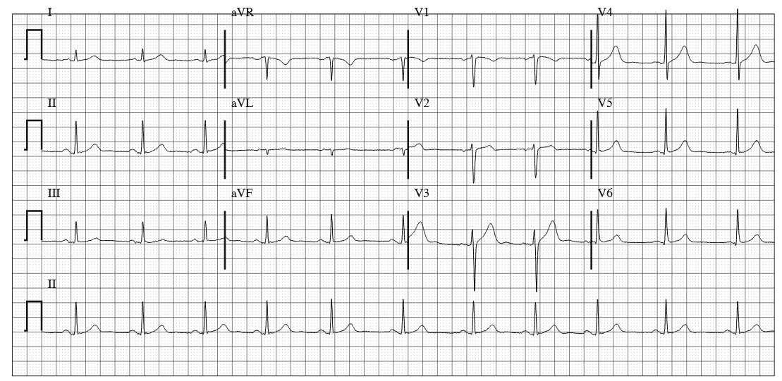 22 Year Old Female With History Of A Recent Syncopal Episode Which 22-year-old-female-with-history-of-a-recent-syncopal-episode-which