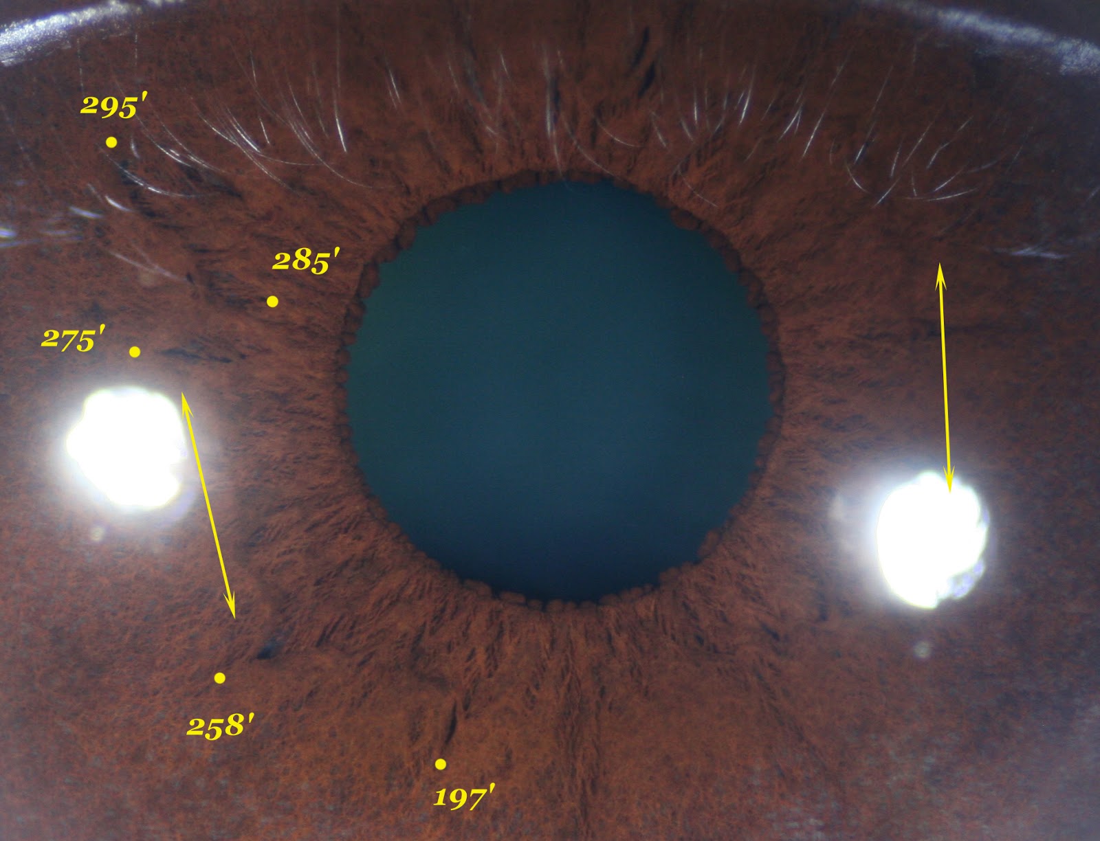 Modern & Multidimensional Iridology: Iris Signs located at inside ...