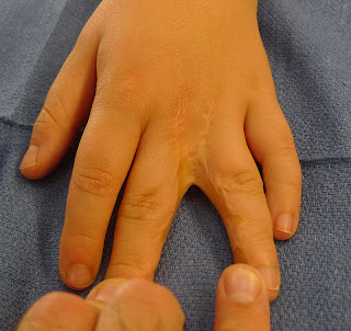 Recurrent Syndactyly | Congenital Hand and Arm Differences | Washington ...