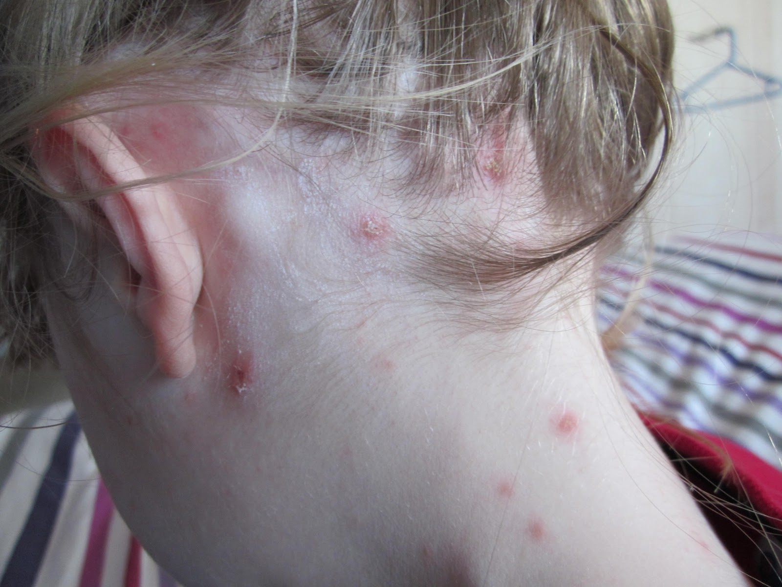 Mummy From The Heart: My Top Tips to Help You Cope with Chickenpox