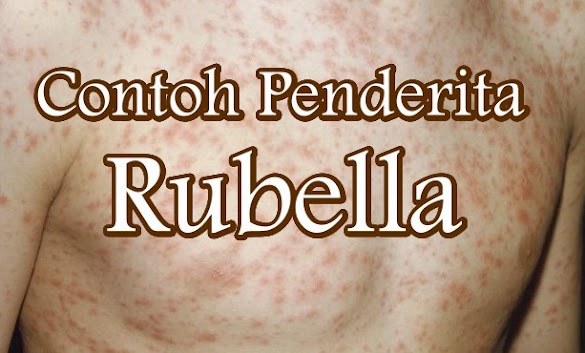 Apa Itu Rubella? Apa Itu Campak? Bagaimana Ciri-Cirinya