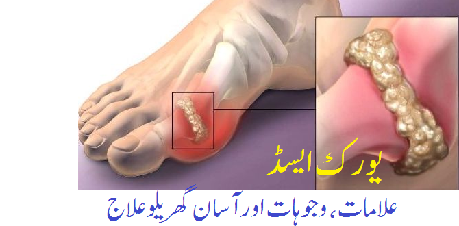 Uric Acid Causes Symptoms & Home Remedies