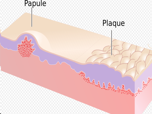 연조직 질환 용어 정리(Macule, patch 등) ~ Healthy Happy