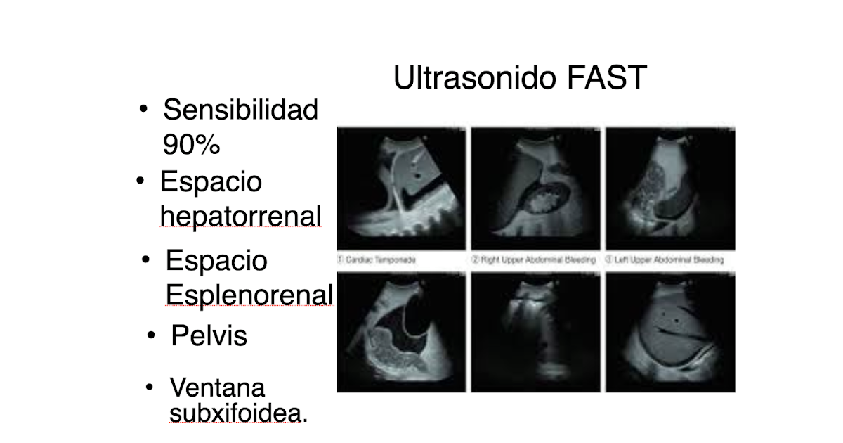 ZONA DE SALUD DE OFRA: Emergency Room Academy. Ultrasonido FAST en ...
