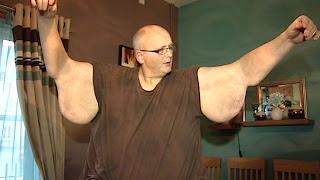 World's fattest man dramatic 650 pounds weight loss ~ Uchenna Udekwe Blog