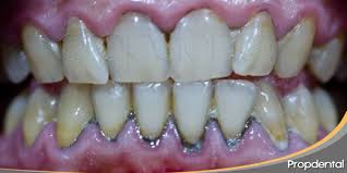 Comienzos de una higienista: Tipos de cálculos dentales: Cálculo ...