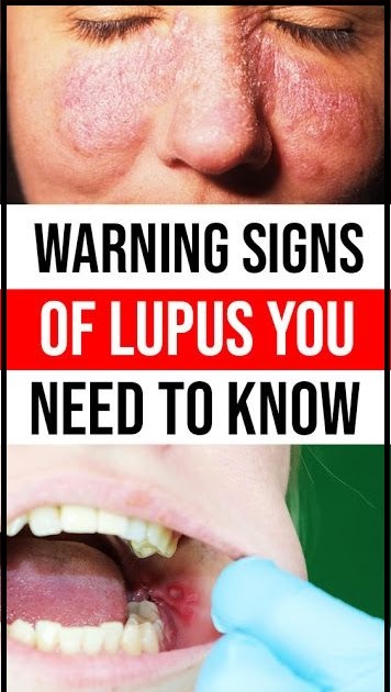 Early Warning Signs of Lupus You Need to Know (And What to Do When You ...