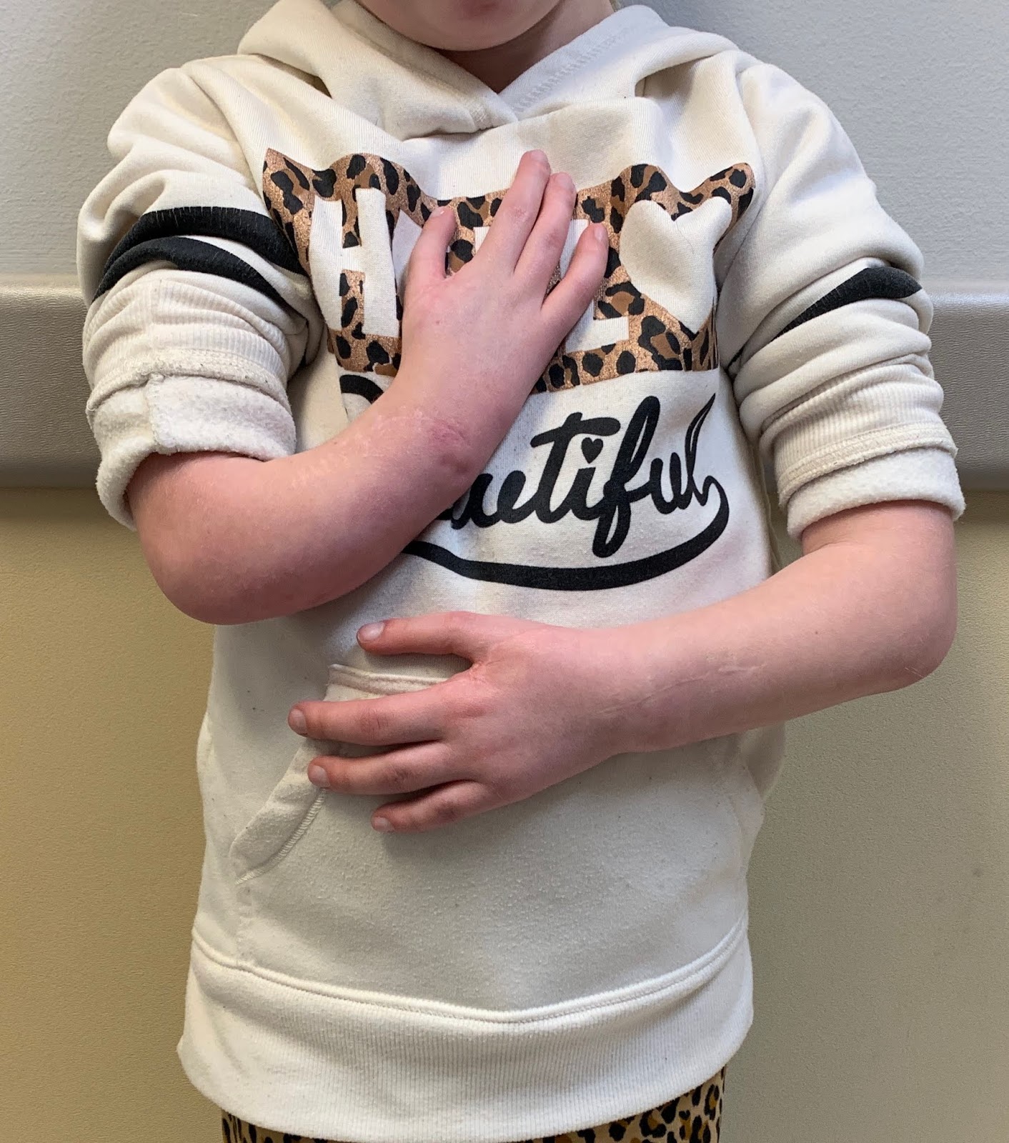 Radial Deficiency Outcome | Congenital Hand and Arm Differences ...