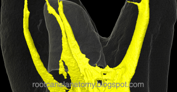 The Root Canal Anatomy Project: Missed MB2 Canal [Maxillary Molars]