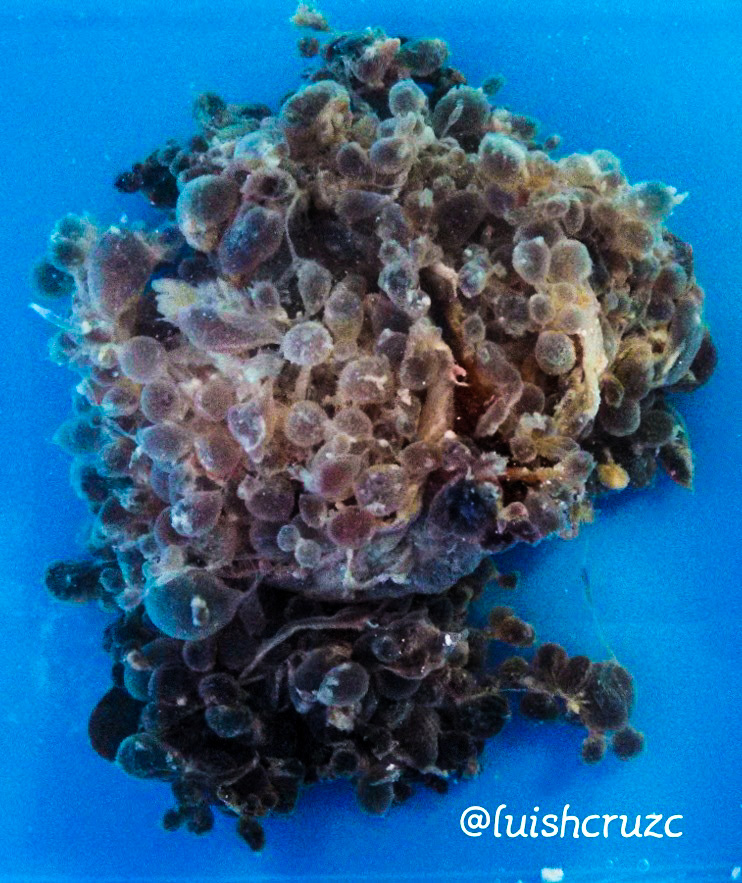 Patología CC: Embarazo molar (Mola hidatiforme completa)