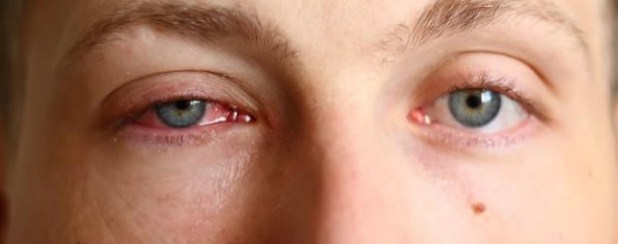 Cara mengobati mata merah sebelah - Farmakepoo