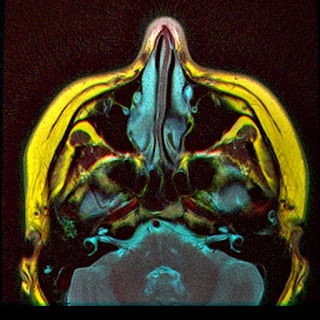 Nevit's blog: Color MRI of Orbita