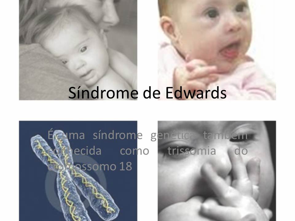 sempre sorrindo: síndrome de Edwards