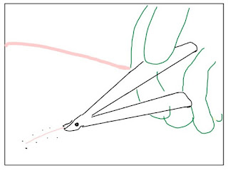 Medicowesome: Suture and Staples removal