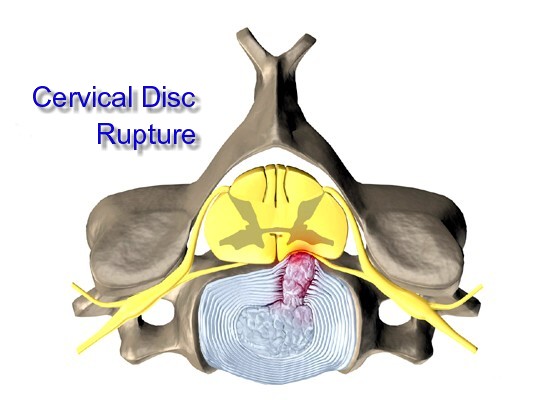 Providence Veterinary Hospital: Canine Cervical Disc Disease