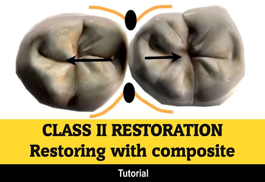 COMPOSITE RESTORATION: Restoring the difficult class II cavity with ...