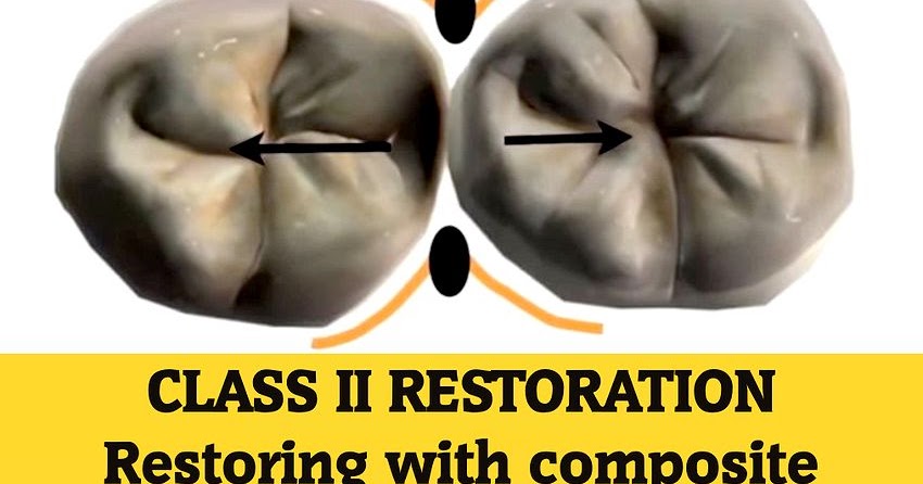 COMPOSITE RESTORATION: Restoring the difficult class II cavity with ...