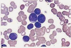 fichero hematologia: Leucemia linfoblástica de células precursoras B. L1