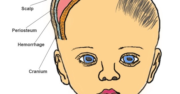 What is a cephalohematoma, and is it dangerous for my baby