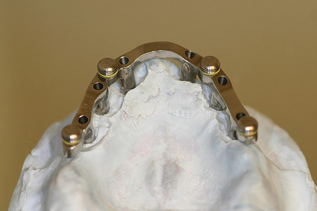 Implant Supported Bar Overdenture parts and cost - Bauer Smiles