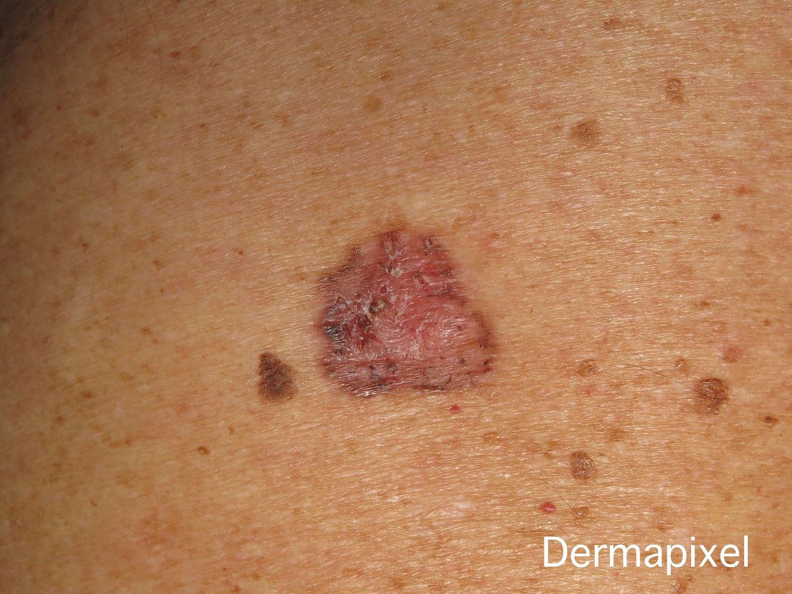 Dermapixel: junio 2019