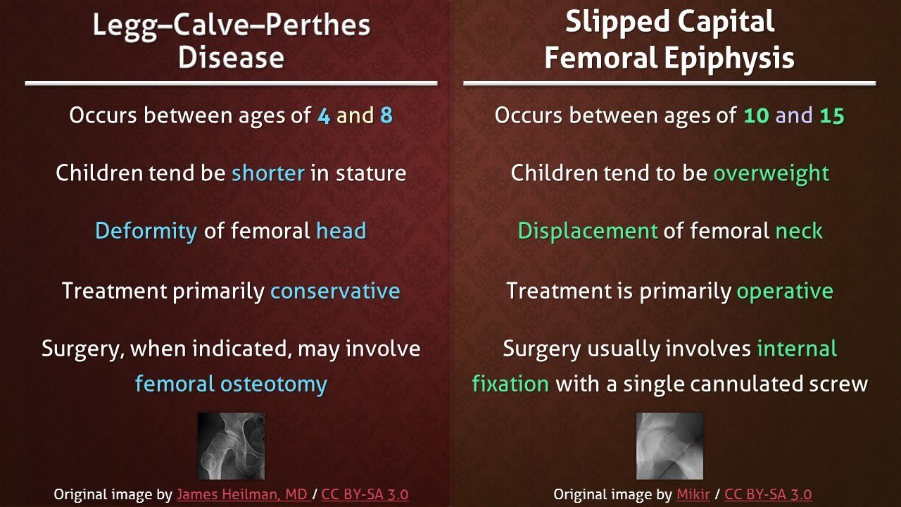 Legg-Calve-Perthes Disease Vs Slipped Capital Femoral Epiphysis